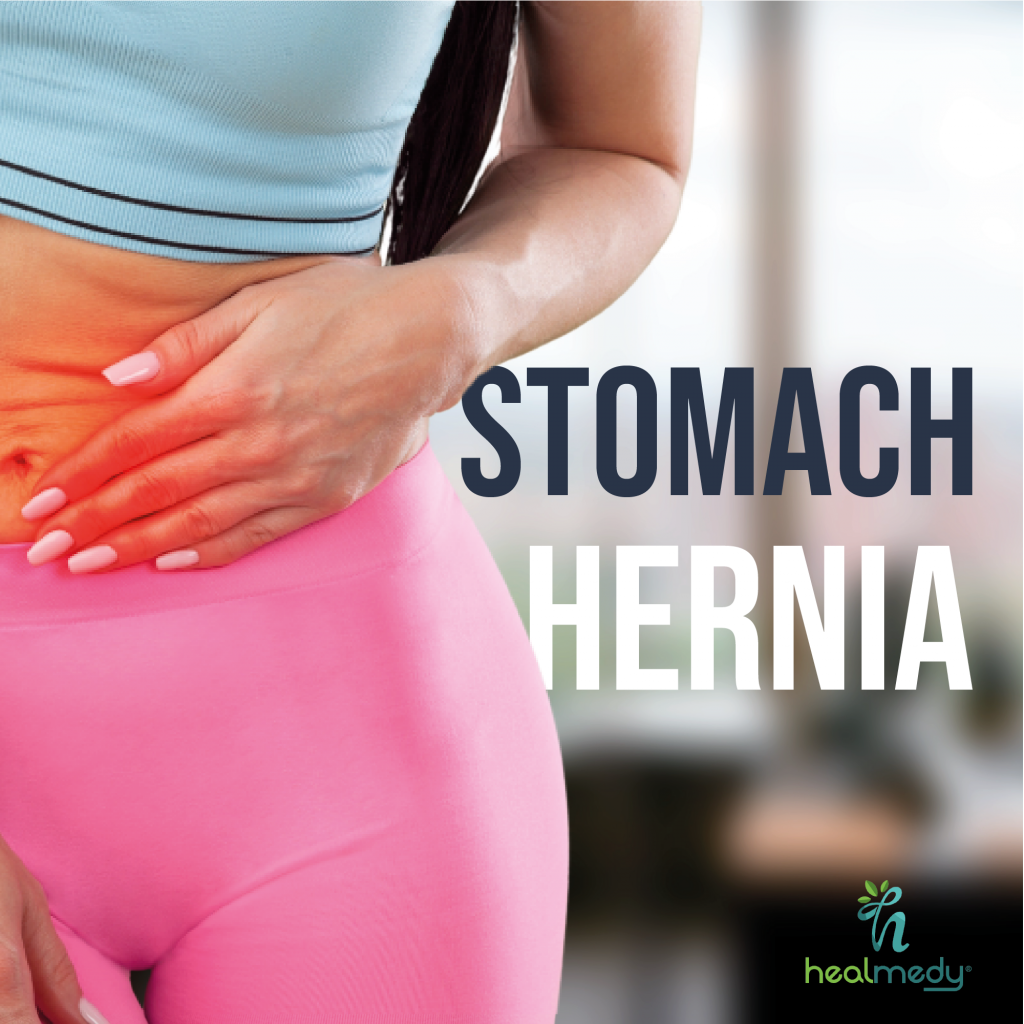 Stomach hernia (Hiatus Hernia) - HEALTCARE CONSULTING SERVICES & SOLUTIONS